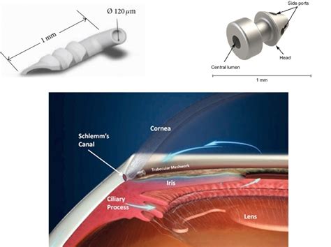 Fig 4 Glaucoma Cataract Care London