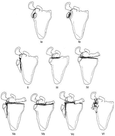Ideberg Classification Modified By Goss Download Scientific Diagram