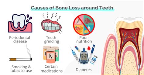 Bone Loss Around Teeth Causes And How To Reverse It Share Dental Care