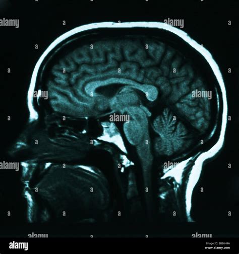 Corpus Callosum Diagram