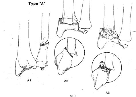 Intra Articular Fractures Semantic Scholar