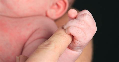 Erythema Toxicum Is A Common Newborn Rash Heres How To Manage It Today S Parent