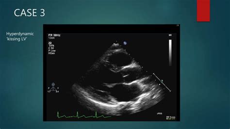 Use Of Bedside Ultrasound In Shock Rush Protocol Pptx Death
