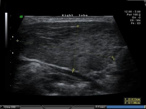 Hemithyroid Agenesis With Hyperthyroidism