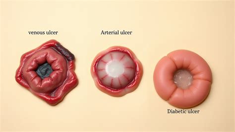 5 Key Differences Venous Ulcer Vs Arterial Ulcer Vs Diabetic Ulcer