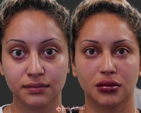 Under Eye Fillers Before And After Results At Skinly