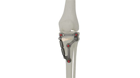 Unix® Metaphyseal Hinge Fixator Response Ortho