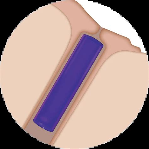 Punctal Occlusion Oasis® Medical