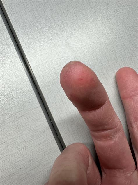 Fingertip Pitting Scars And Calcification R Scleroderma