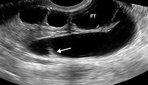 Imaging Evaluation Of Fallopian Tubes And Related Disease A Primer For