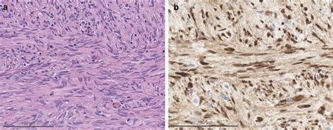 Hematoxylin And Eosin Staining Of The Tumor A And Download Scientific Diagram