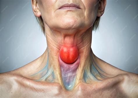 Pictures Of Swollen Thyroid Gland In Neck Premium Ai Generated Image