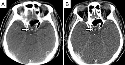 Figure1 A Head Ct Taken In 2012 Showed A Thickened Pituitary Stalk B Download Scientific