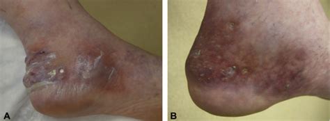 Intractable Pyoderma Gangrenosum In A Crohns Disease Patient On Vedolizumab Jaad Case Reports