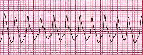 Interpreting A 12 Lead Electrocardiogram 12 Lead Ecg Resources Acls Certification Association