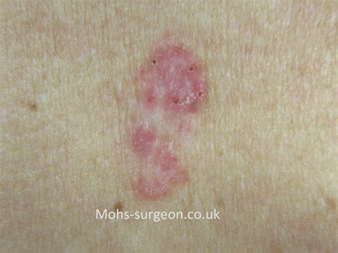 Bcc On Back Basal Cell Carcinoma Picture Mr Tehrani Mohs Surgeon