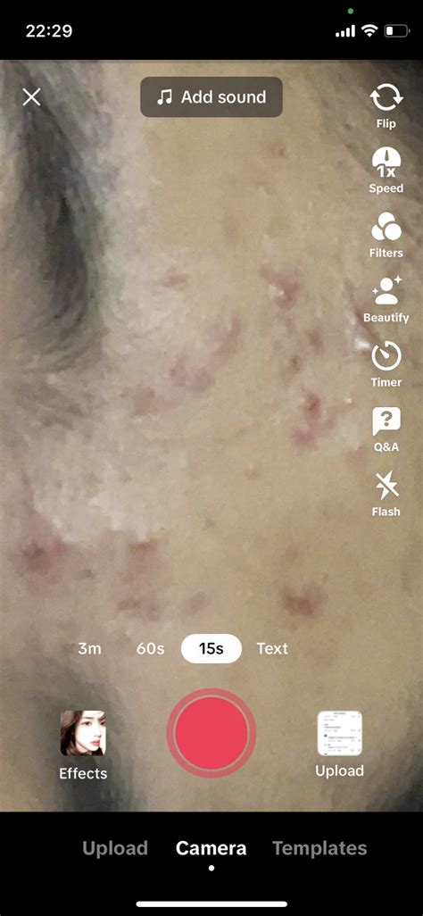 이런 여드름 없애는 방법 좀요 ㅠ 지식in