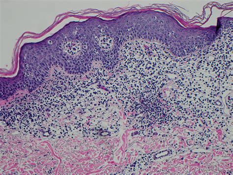 Annular Erythematous Plaques On The Back Mdedge