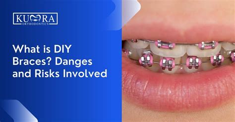 What Are Diy Braces Dangers And Risks Involved Kumra Orthodontics