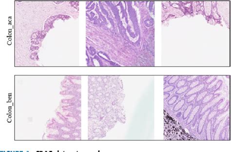 Figure 1 From Classification Of Lung And Colon Cancer Histopathological Images Using Global