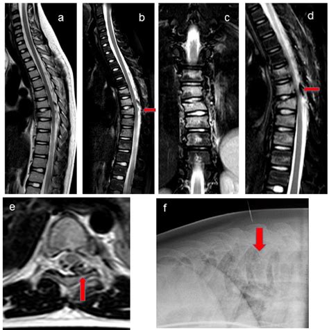 Cl A B C Mri Showing T7 Burst Fracture T5 T6 T8 T9 T10 Anterior Download Scientific