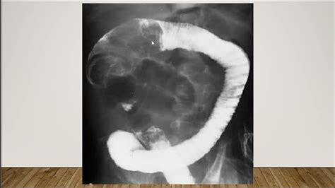 Intussusception Claw Sign