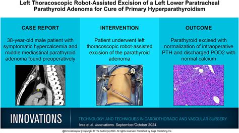 Left Thoracoscopic Robot Assisted Excision Of A Left Lower Paratracheal