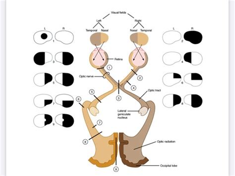 Visual Pathway Defect Flashcards Quizlet