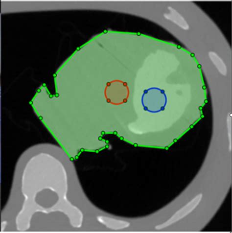 Placement Of The Two Rois For Contrast To Noise Ratio Cnr Download Scientific Diagram