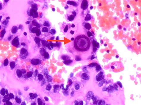 Thyroid Microcalcifications In The Absence Of Identifiable Nodules And