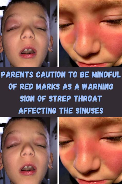 Strep Infection Sinuses At Melvin Lucy Blog