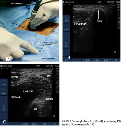Figure 2 From Ultrasound Guided Suprainguinal Fascia Iliaca Block To Position The Patient For