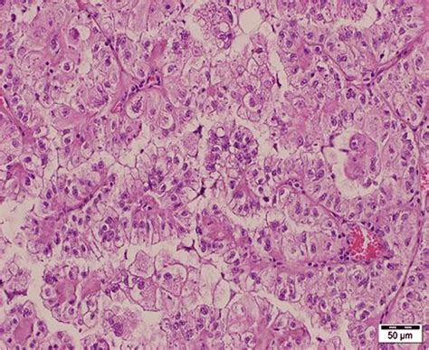 Papillary Renal Cell Carcinoma Type Papillary Structures Covered Download Scientific