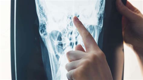 Ai Twice As Accurate At Pinpointing Stroke Time Than Current Methods