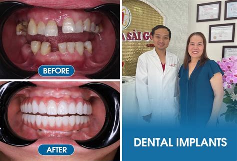 Understanding All On 6 Dental Implants Saigon Implant Center