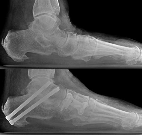 Foot And Ankle Surgery Academy On Linkedin Significant Posterior