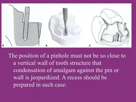 Complex Amalgam Restorations Pptx Dental Health Diseases And Conditions