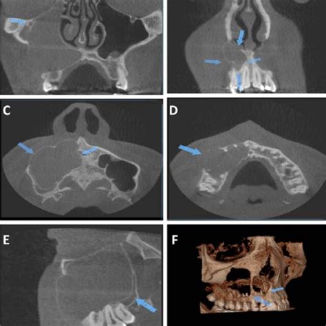 Cone Beam Computed Tomography Cbct Scans Of The Radicular Cyst In Download Scientific