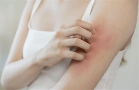 Nodular Prurigo Clearskin Dermatology Treatment Clinic