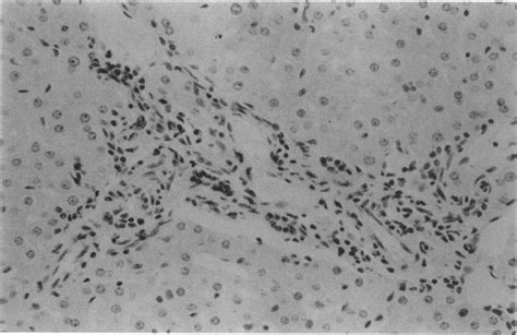 Photomicrograph Of Liver Biopsy Revealing Minor Focal Pericholangitis