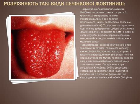 Патоморфологія жовтяниці гемолітична паренхіматозна механічна презентация онлайн