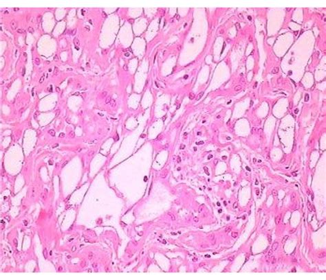 Adenomatoid Tumor Of Epididymidis A Case Report Cases Journal Full Text