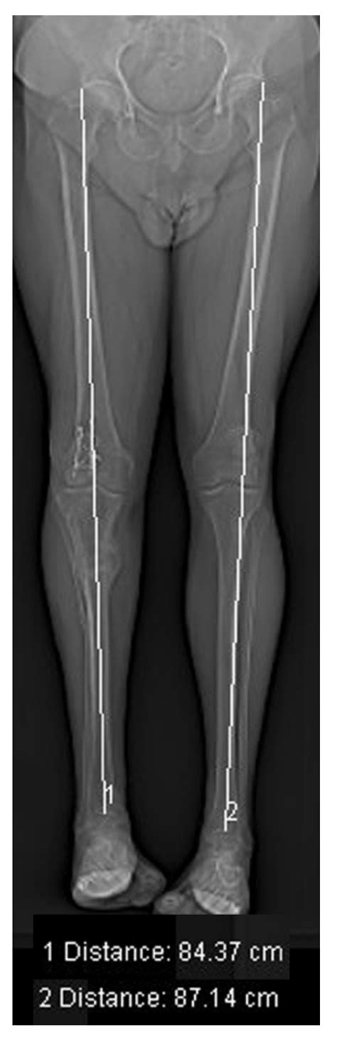 Ct Scanogram For Limb Length Discrepancy In Comminuted 56 Off