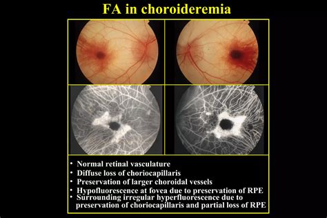 47 Hereditary Choroidal Dystropathies Ppt