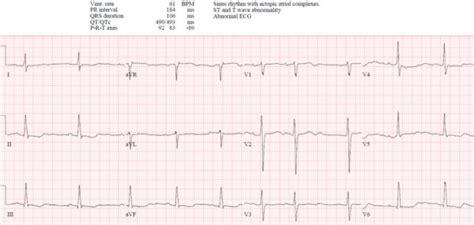 Beware Computer Interpretation Errors Ecg Cases Em Cases