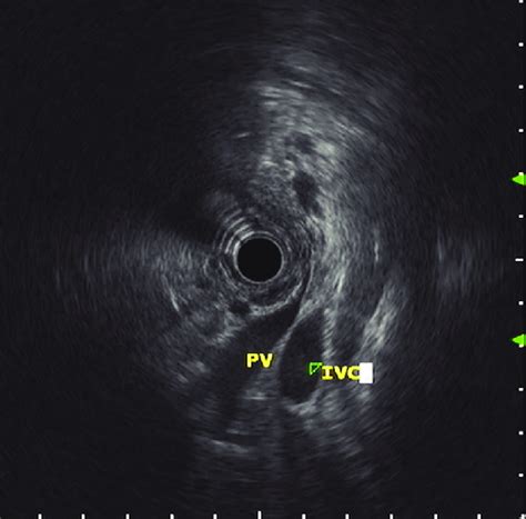The Portal Vein And Inferior Vena Cava Can Be Seen In Long Orientation