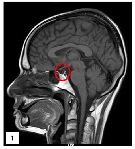 T1 Weighted Image Sagittal Section Shows Empty Sella Filled With CSF