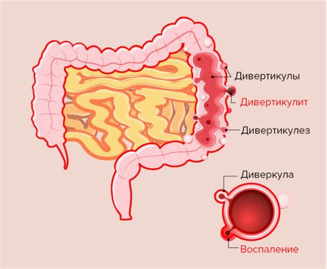 Polyps And Diverticula Colon Polyps And Diverticulitis Understanding The Differences And