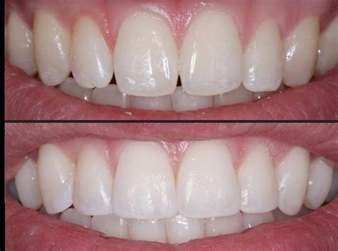 Composite Bonding The Art Of Smile Transformation Just Smilez Dental