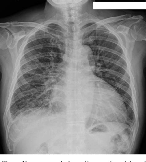 Figure 1 From Methamphetamine Induced Cardiotoxicity With Heart Failure